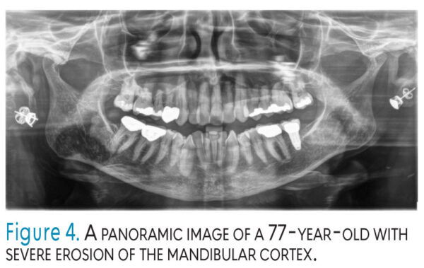 Tips for Identifying Systemic Conditions and Anomalies on the Panoramic ...