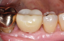 The Concept of Biologic Width in Restorative Dentistry - Dimensions of ...