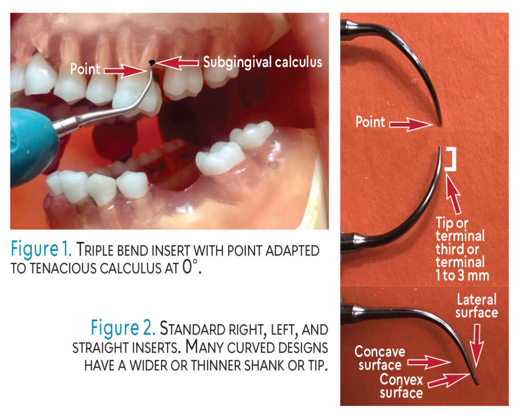 Mastering Ultrasonic Instrumentation for Stage I Periodontitis ...