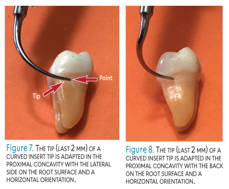 Mastering Ultrasonic Instrumentation for Stage I Periodontitis ...