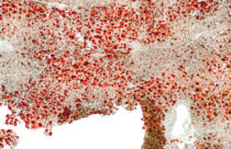 Treating Herpetic Lesions With Laser Therapy