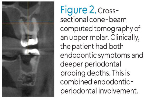 CBCT in Periodontics - Dimensions of Dental Hygiene