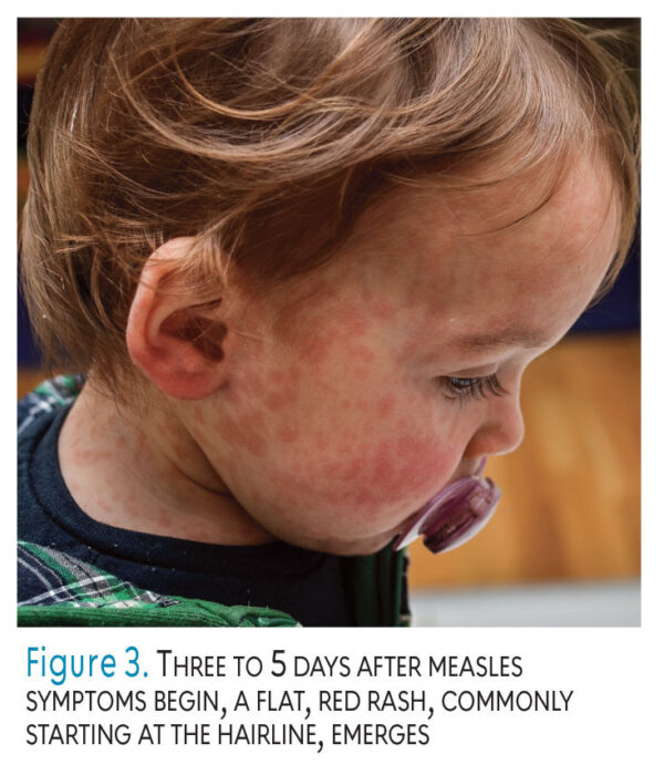 The Re-Emergence of Measles - Dimensions of Dental Hygiene