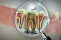 The Concept of Biologic Width in Restorative Dentistry - Dimensions of ...