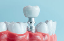 The Concept of Biologic Width in Restorative Dentistry - Dimensions of ...