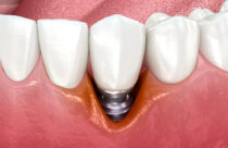 Maggots in the Mouth: The Rare but Hidden Peril of Oral Myiasis ...