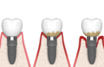 The Concept of Biologic Width in Restorative Dentistry - Dimensions of ...