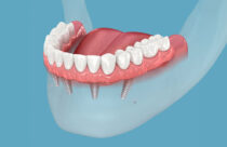 The Concept of Biologic Width in Restorative Dentistry - Dimensions of ...