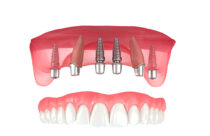 The Concept of Biologic Width in Restorative Dentistry - Dimensions of ...