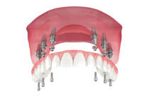 The Concept of Biologic Width in Restorative Dentistry - Dimensions of ...