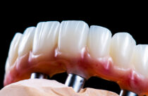 The Concept of Biologic Width in Restorative Dentistry - Dimensions of ...