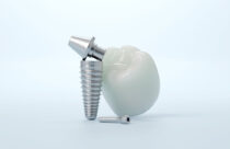 The Concept of Biologic Width in Restorative Dentistry - Dimensions of ...