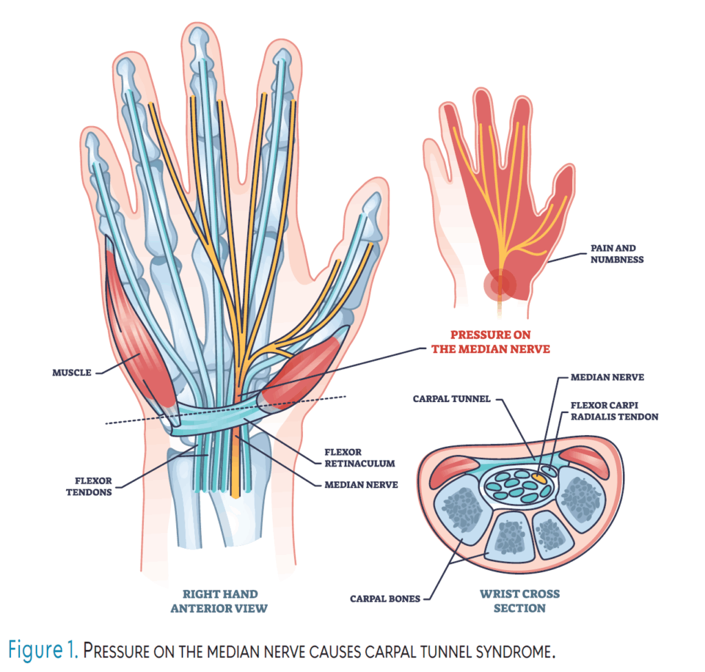 Carpal Tunnel Syndrome Demystified - Dimensions of Dental Hygiene