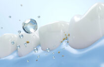 Polishing Protocol - Dimensions of Dental Hygiene