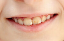 Dental Therapy Gains Momentum as a Solution to Expanding Oral ...